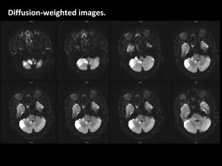 Right AICA PICA stroke | PPT