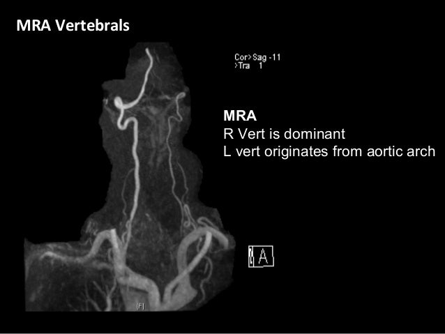 Right AICA PICA stroke