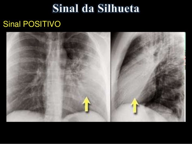 SINAIS EM RADIOLOGIA TORÁCICA 2.0