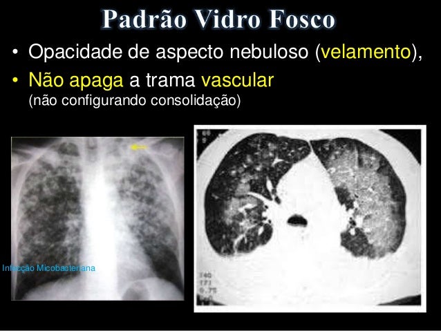 SINAIS EM RADIOLOGIA TORÁCICA 2.0