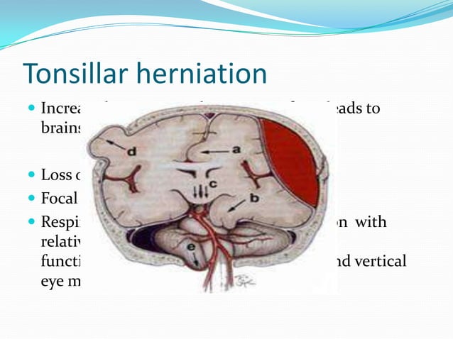 Raised Intracranial Pressure | PPTX