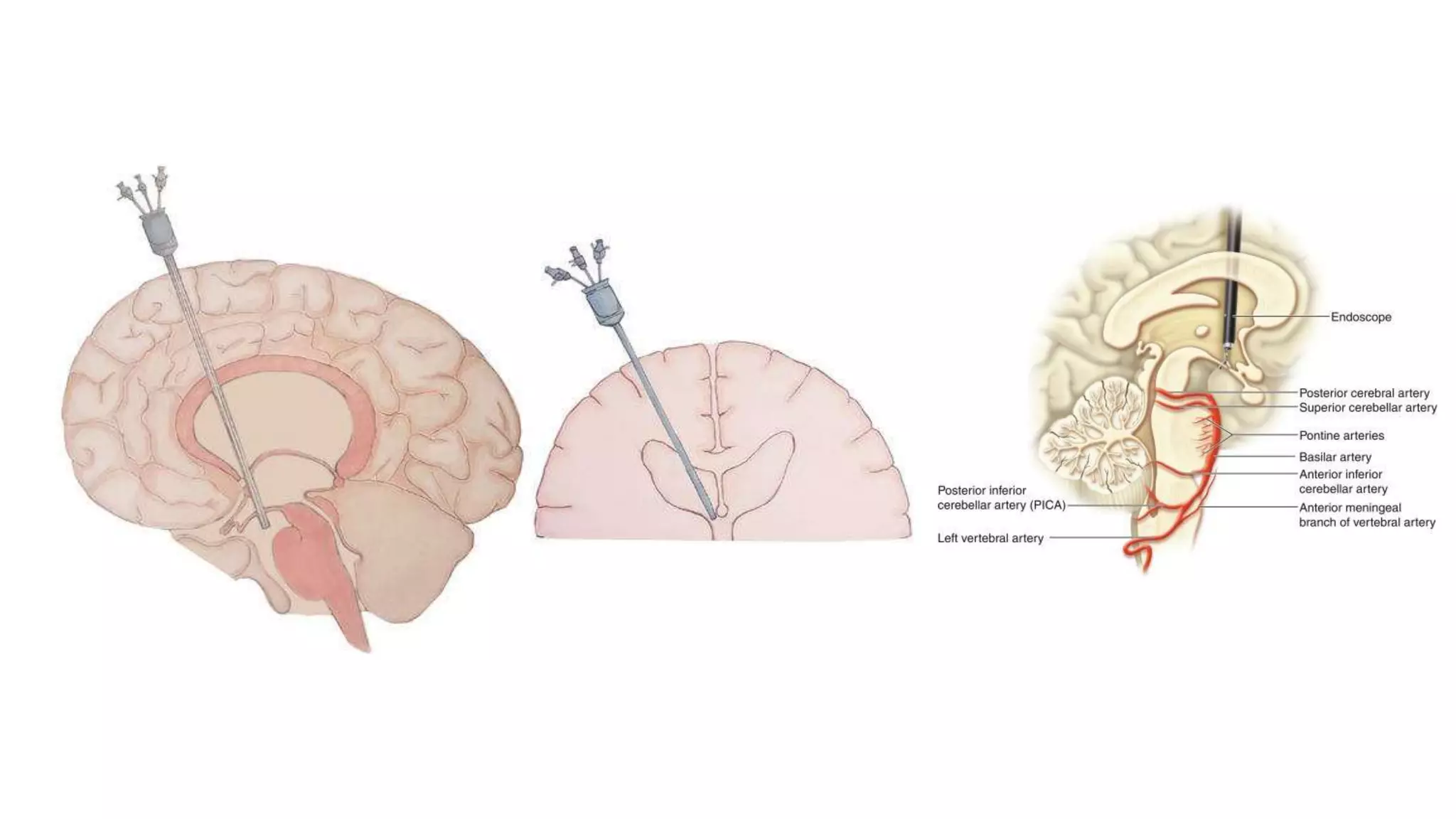 Raised intracranial pressure | PPTX