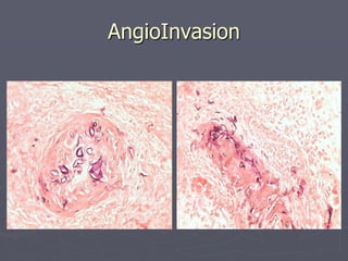 Case Presentation 1 ICU | PPSX