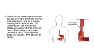 Esophageal strictures caused by caustic burns.pptx