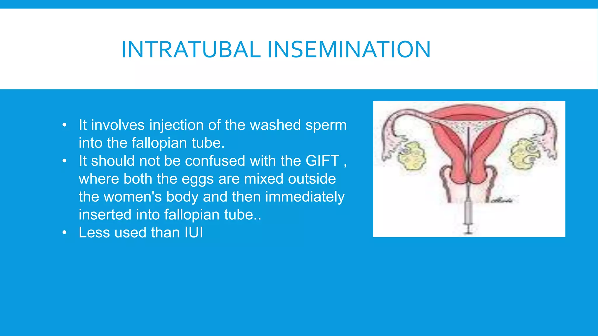 assisted reproductive technology | PPTX