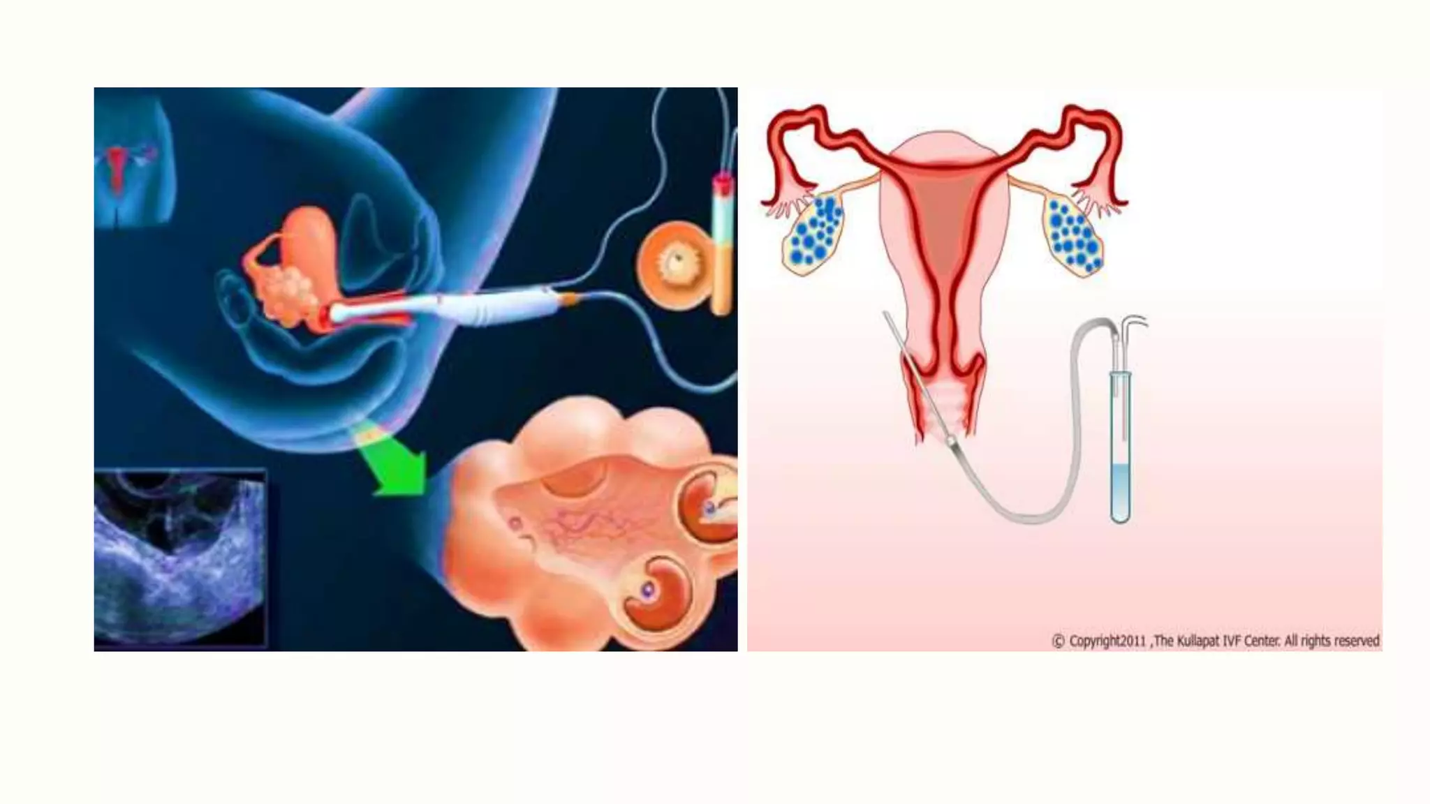 Assisted Reproductive Technology Ppt