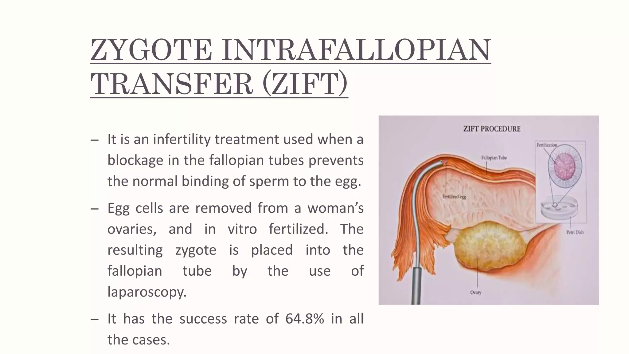 assisted reproductive technology | PPTX