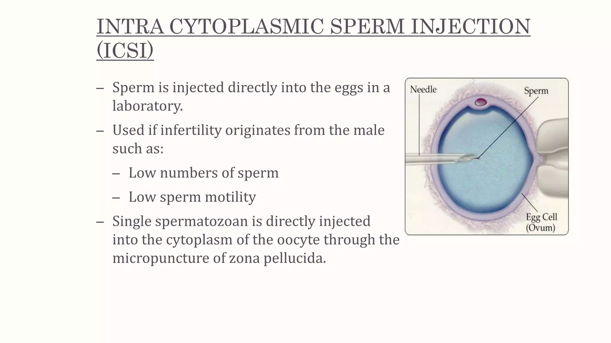 assisted reproductive technology | PPTX