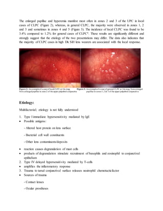 Giant Papillary Conjunctivitis Treatment