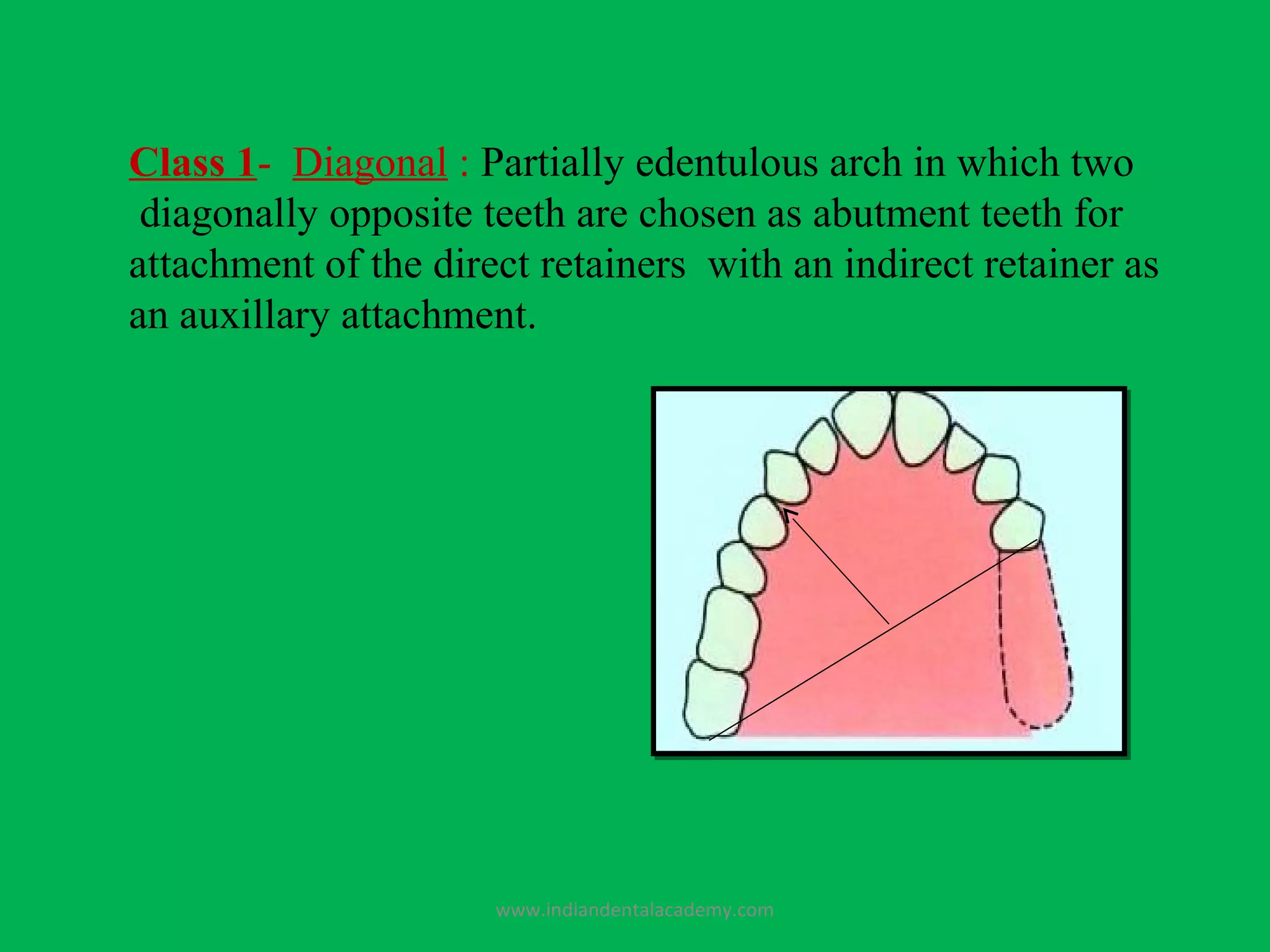rpd classification final / dental implant courses by Indian dental ...