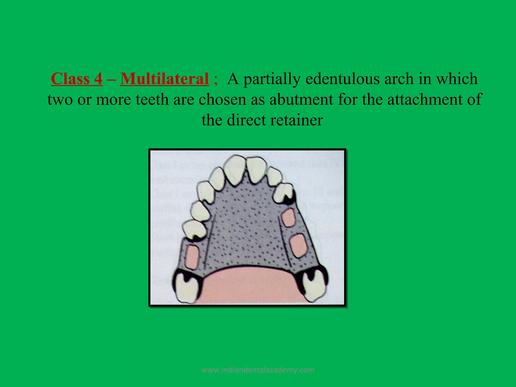 rpd classification final / dental implant courses by Indian dental ...