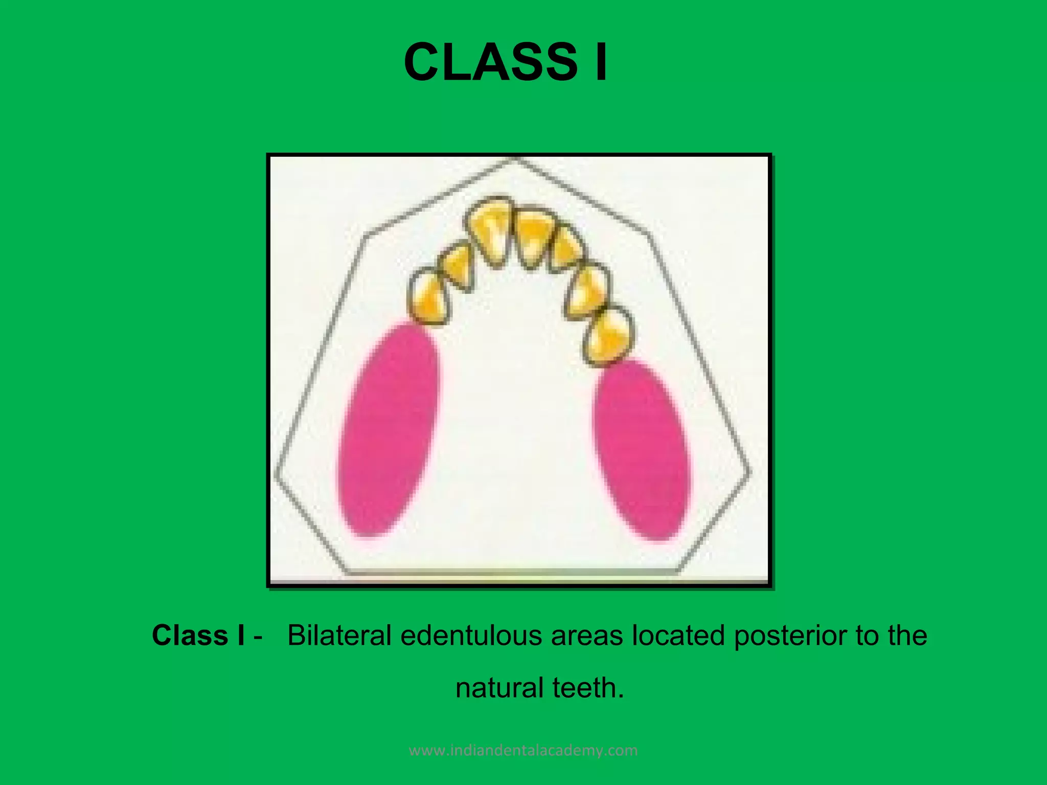rpd classification final / dental implant courses by Indian dental ...