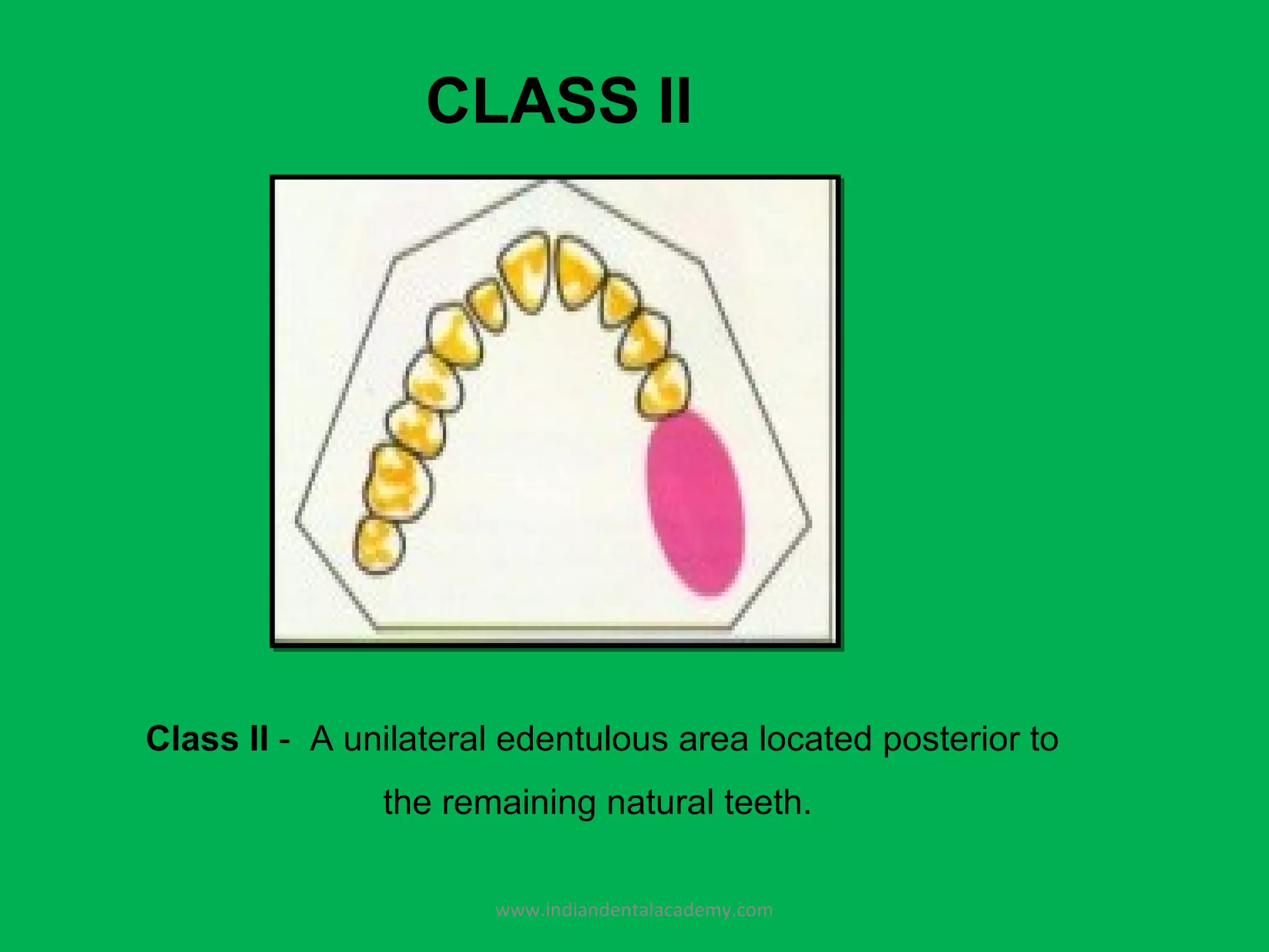 rpd classification final / dental implant courses by Indian dental ...