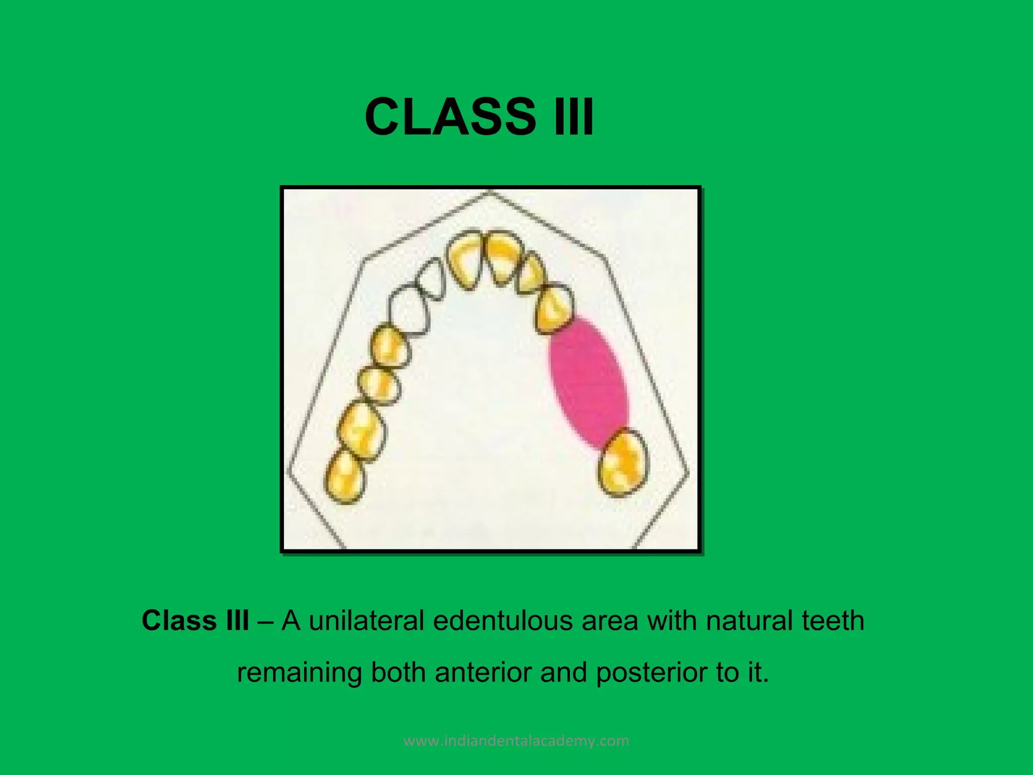 rpd classification final / dental implant courses by Indian dental ...