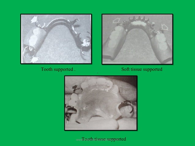 rpd classification final / dental implant courses by Indian dental ...