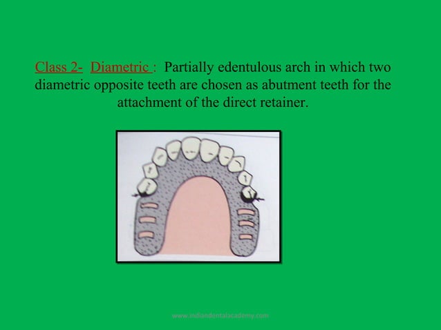 rpd classification final / dental implant courses by Indian dental ...