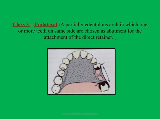 rpd classification final / dental implant courses by Indian dental ...