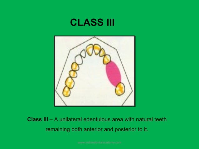 rpd classification final / dental implant courses by Indian dental ...