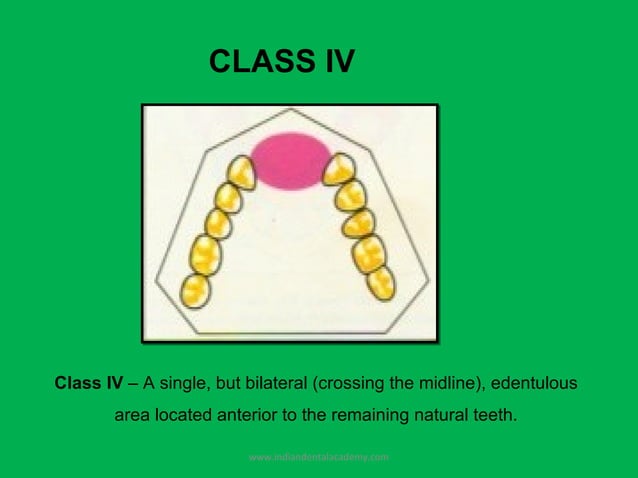 rpd classification final / dental implant courses by Indian dental ...