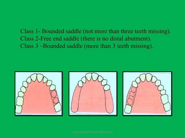 rpd classification final / dental implant courses by Indian dental ...