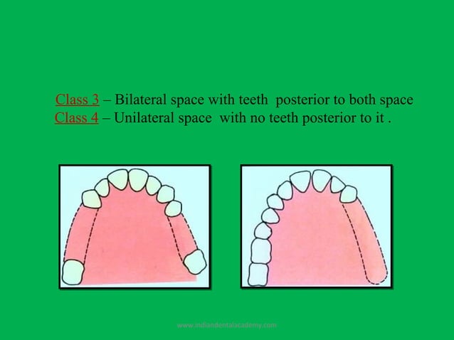rpd classification final / dental implant courses by Indian dental ...