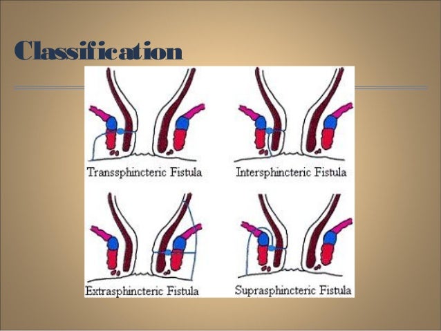 Rakesh benign-anorectal-