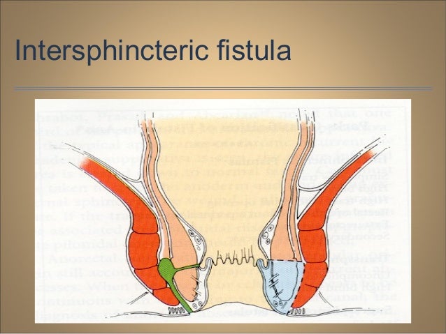 Rakesh benign-anorectal-