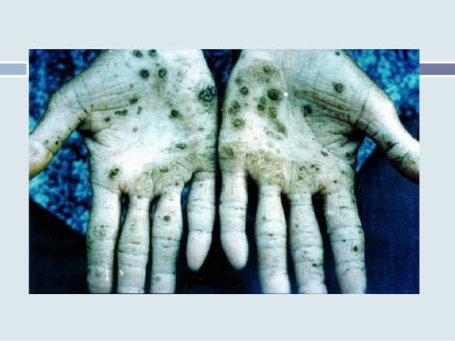 Rak kao profesionalna bolest