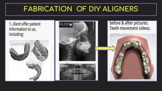 DIY Aligners.pptx