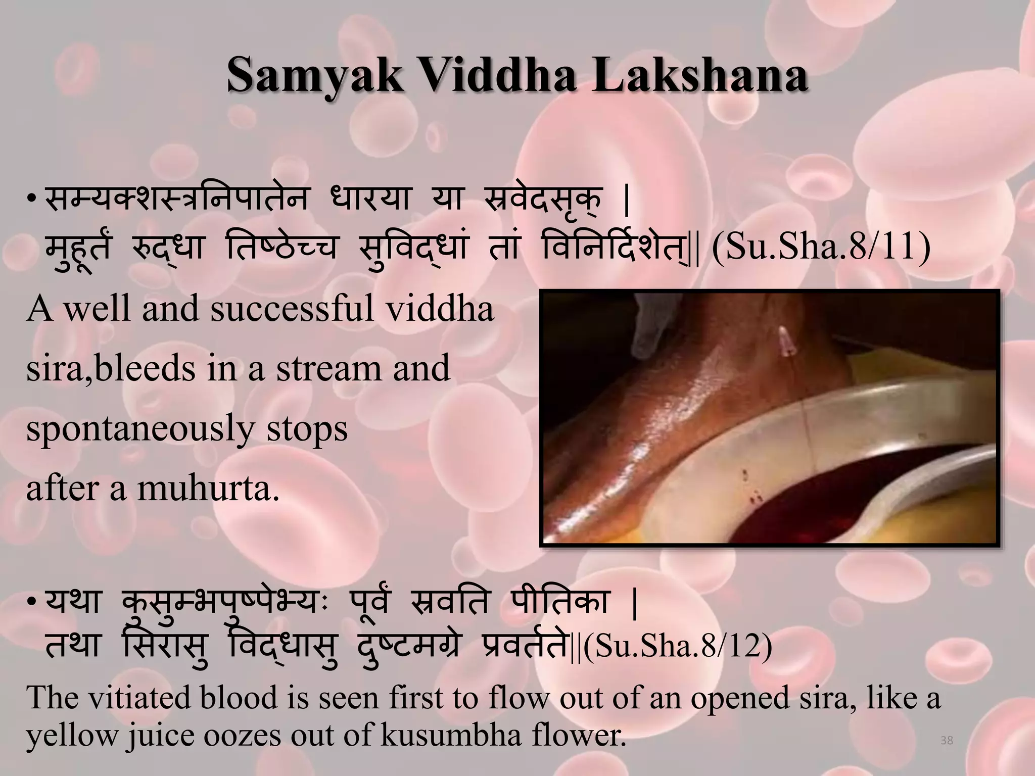 Rakta mokshana - Siravyadha | PPTX