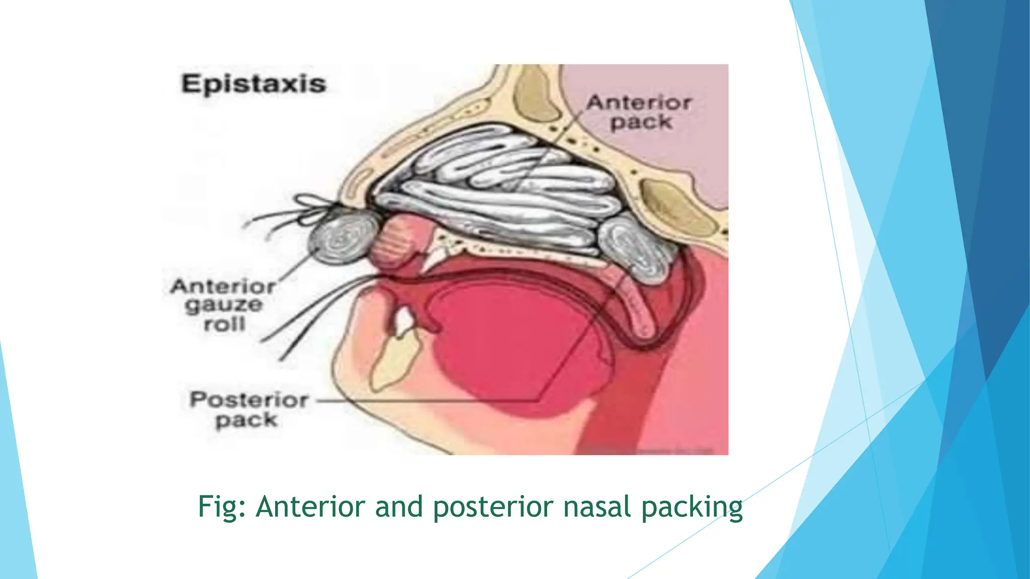 Treatment of epistaxis with their clinical features | PPTX