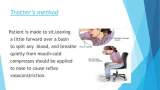 Treatment of epistaxis with their clinical features | PPTX