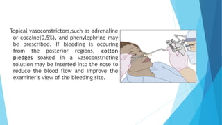 Treatment of epistaxis with their clinical features | PPTX