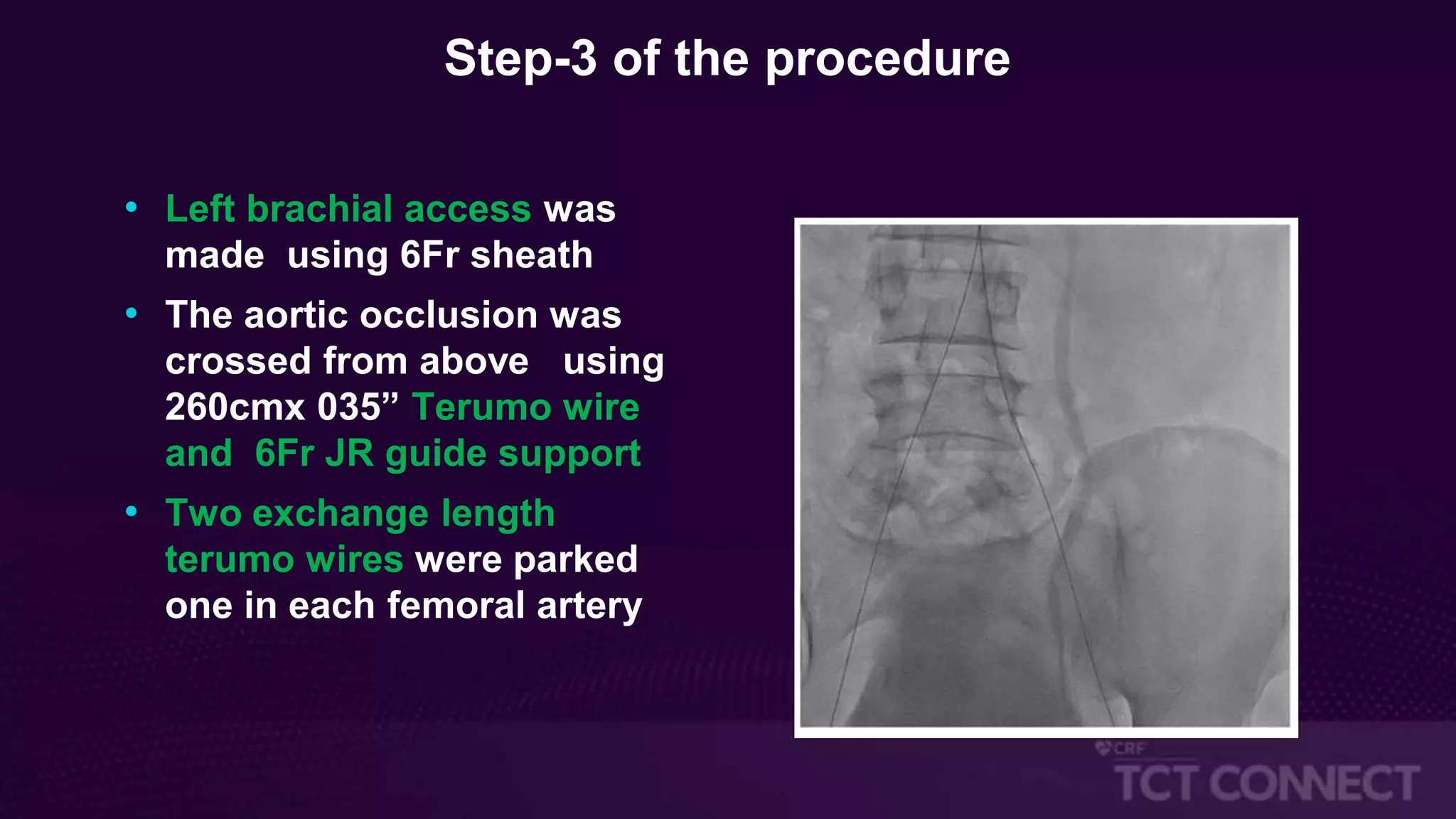 Distal Abdominal Aorta and Common Aliac Arteries Total Occlusion ...