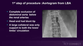 Distal Abdominal Aorta and Common Aliac Arteries Total Occlusion ...