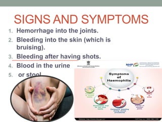 Hemophilia and Autoimmune hemolytic anemia | PPT