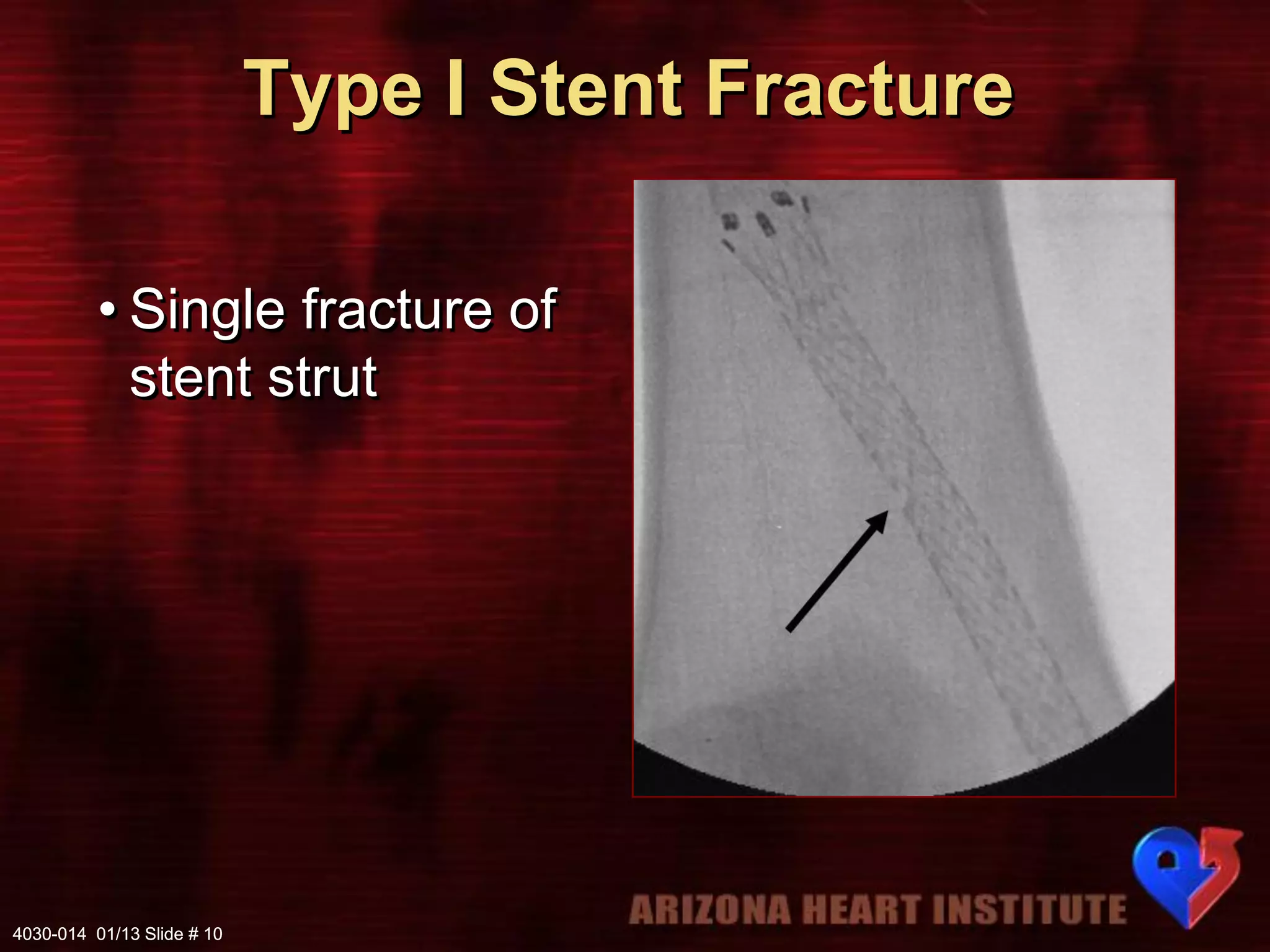 Jet Stream Pathway Device in Peripheral Arterial Disease. | PDF