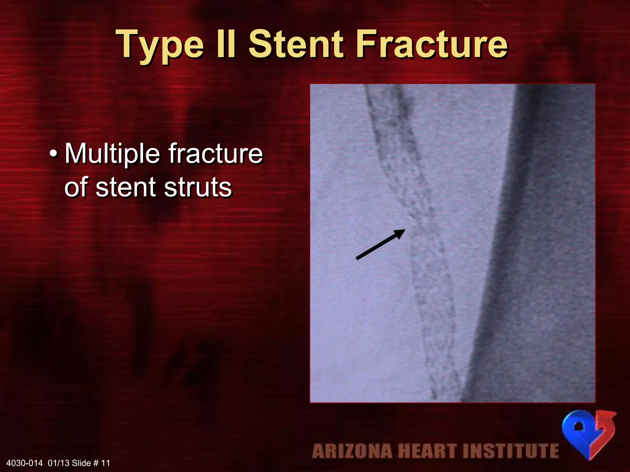 Jet Stream Pathway Device in Peripheral Arterial Disease. | PDF
