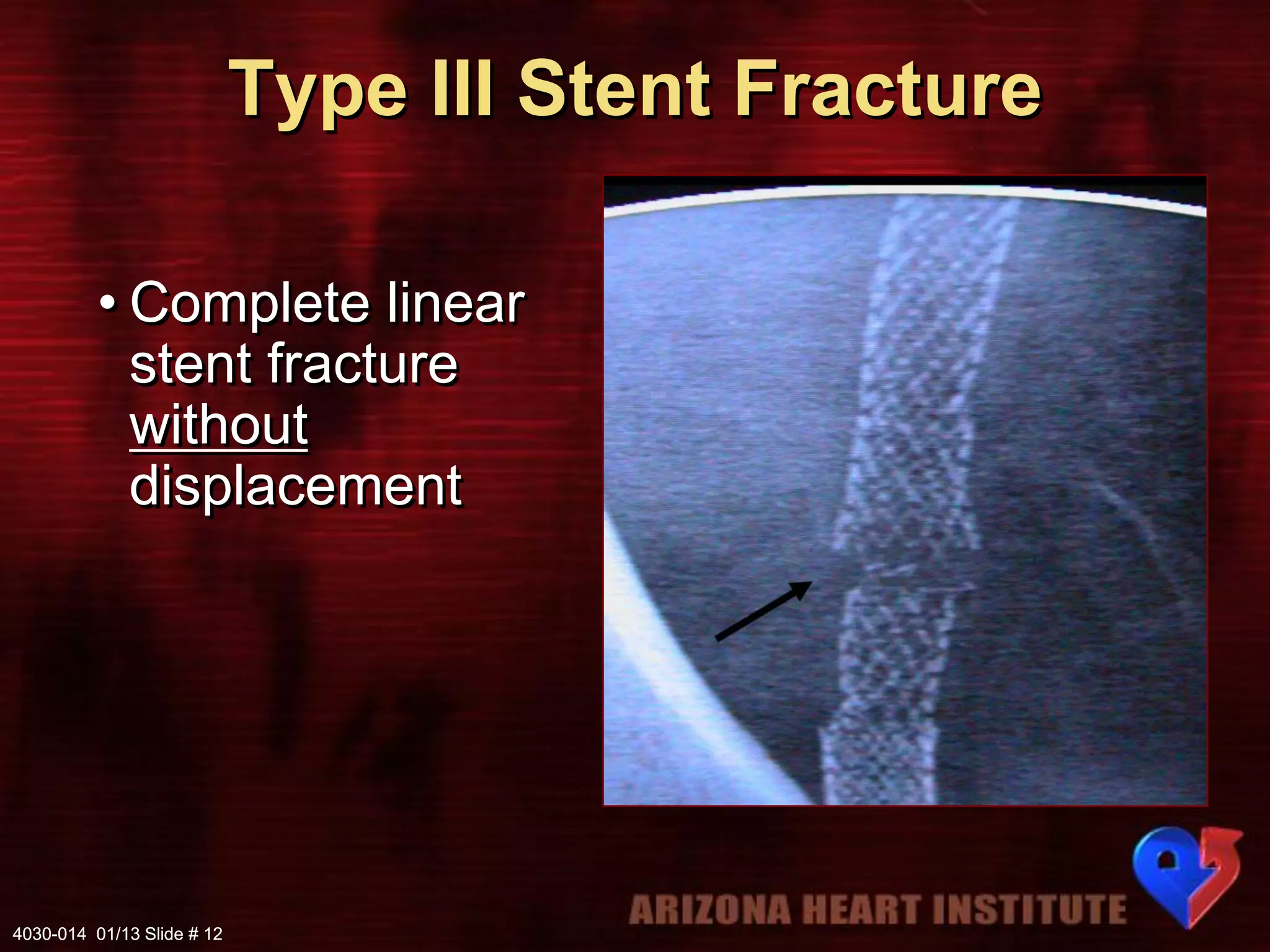 Jet Stream Pathway Device in Peripheral Arterial Disease. | PDF