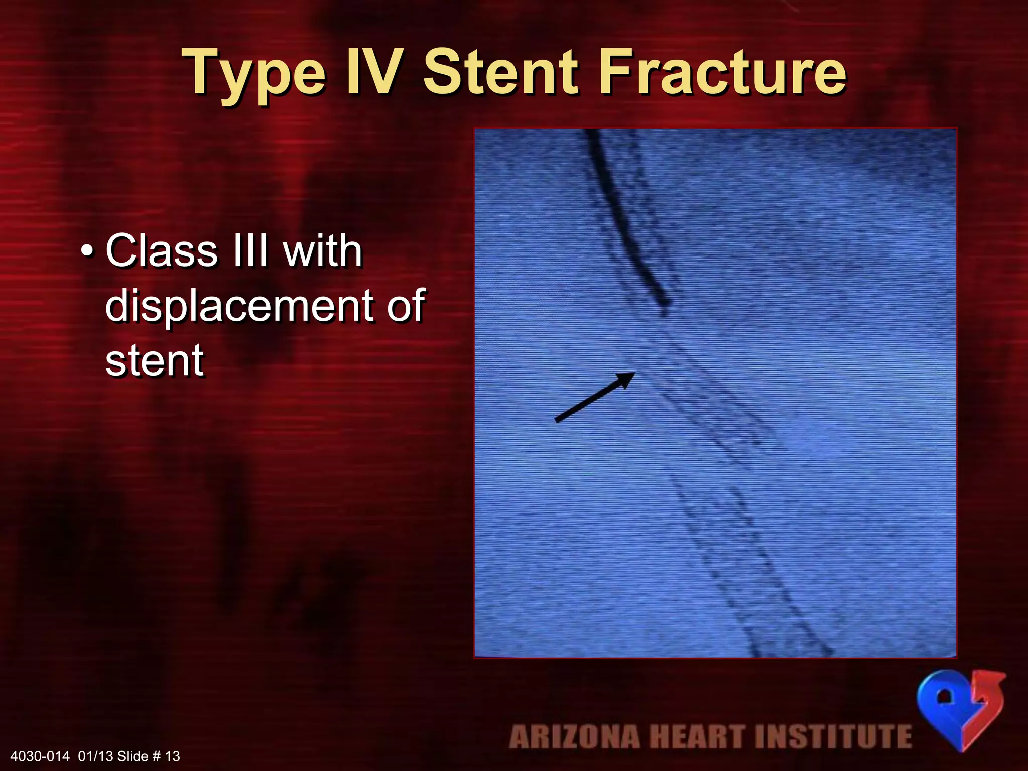 Jet Stream Pathway Device in Peripheral Arterial Disease. | PDF