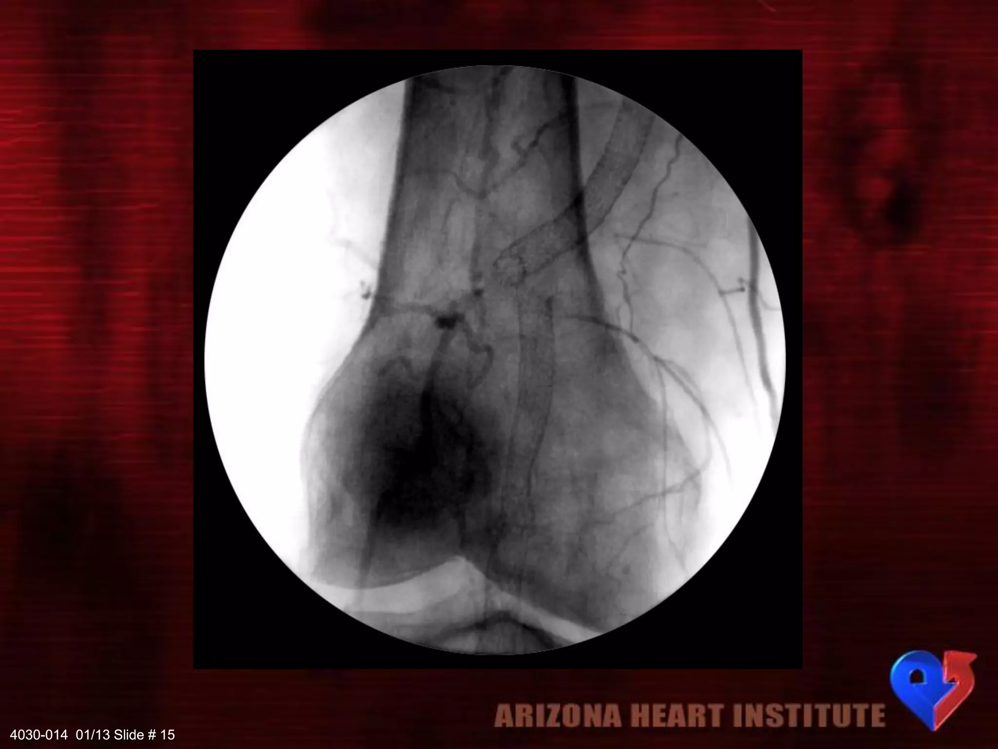 Jet Stream Pathway Device in Peripheral Arterial Disease. | PDF