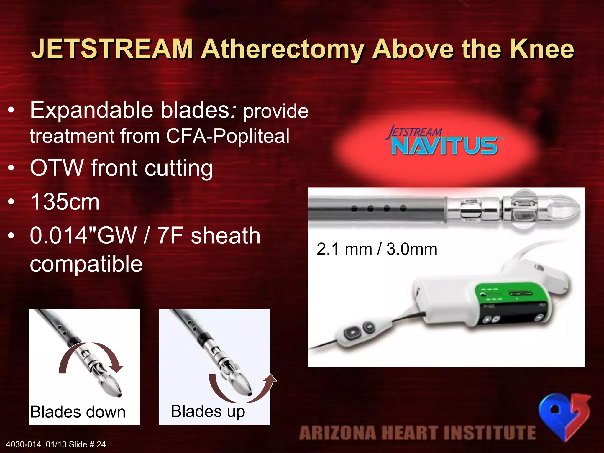 Jet Stream Pathway Device in Peripheral Arterial Disease. | PDF