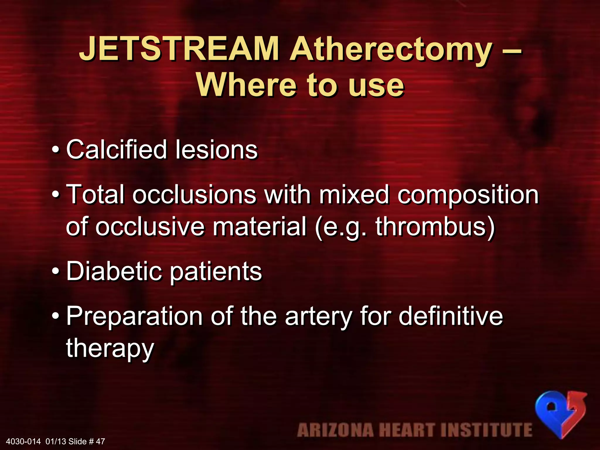 Jet Stream Pathway Device in Peripheral Arterial Disease. | PDF