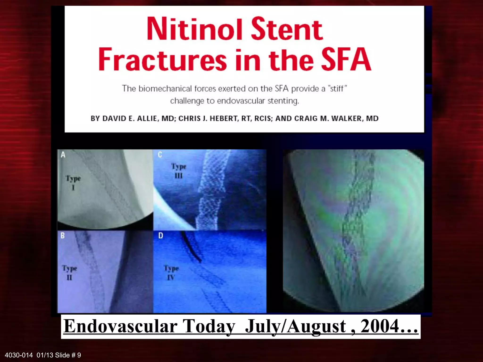 Jet Stream Pathway Device in Peripheral Arterial Disease. | PDF