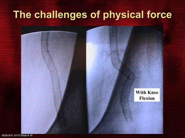 Jet Stream Pathway Device in Peripheral Arterial Disease. | PDF