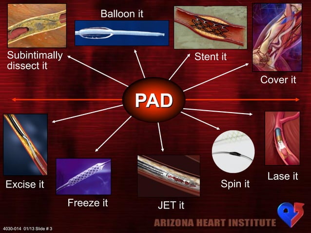Jet Stream Pathway Device in Peripheral Arterial Disease. | PDF