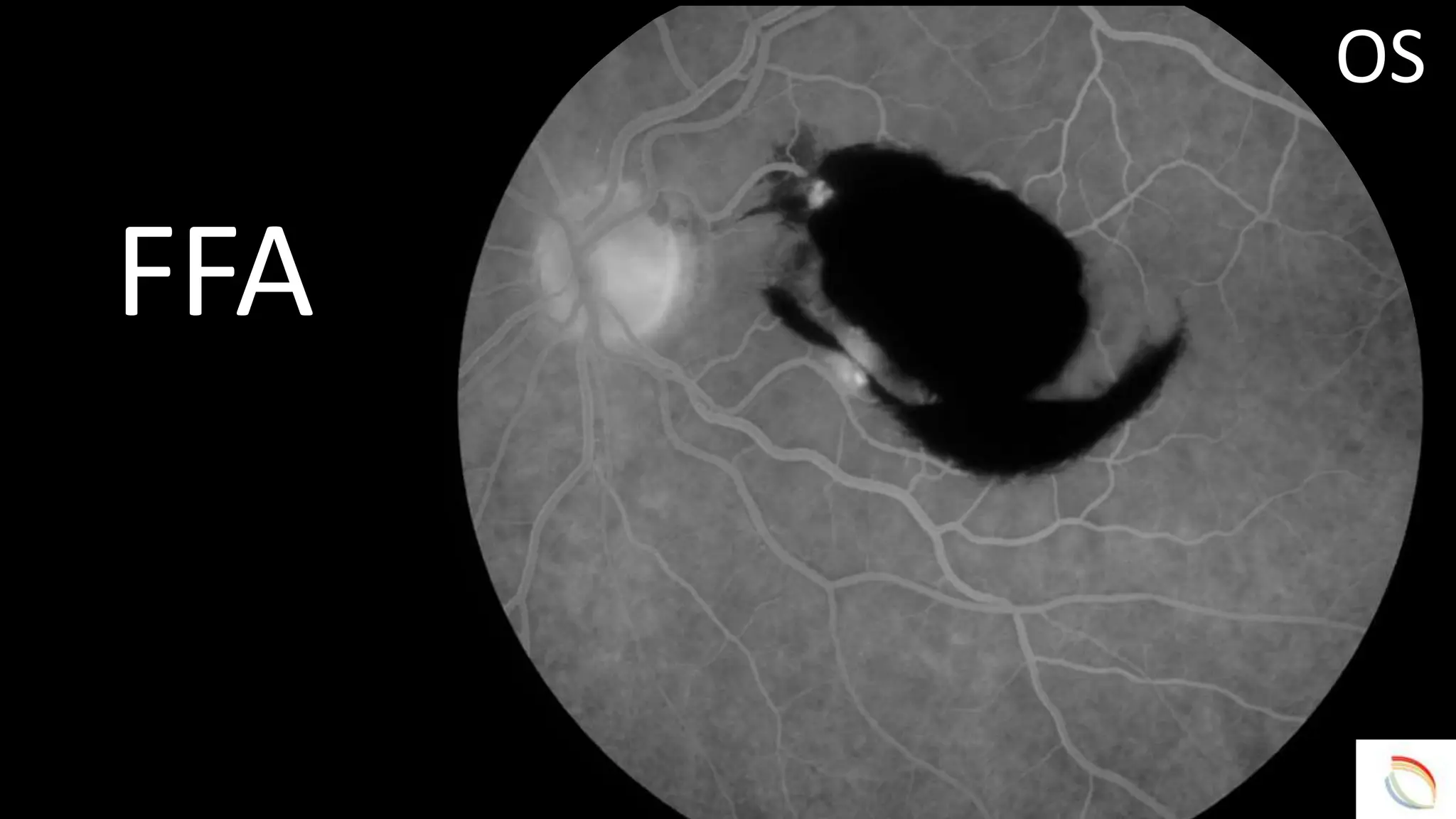 Retinal Artery Macroaneurysm | PPTX