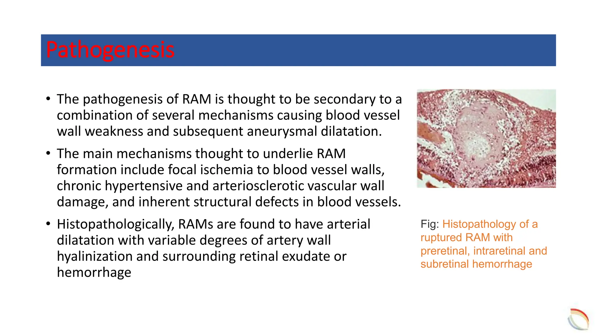 Retinal Artery Macroaneurysm | PPTX