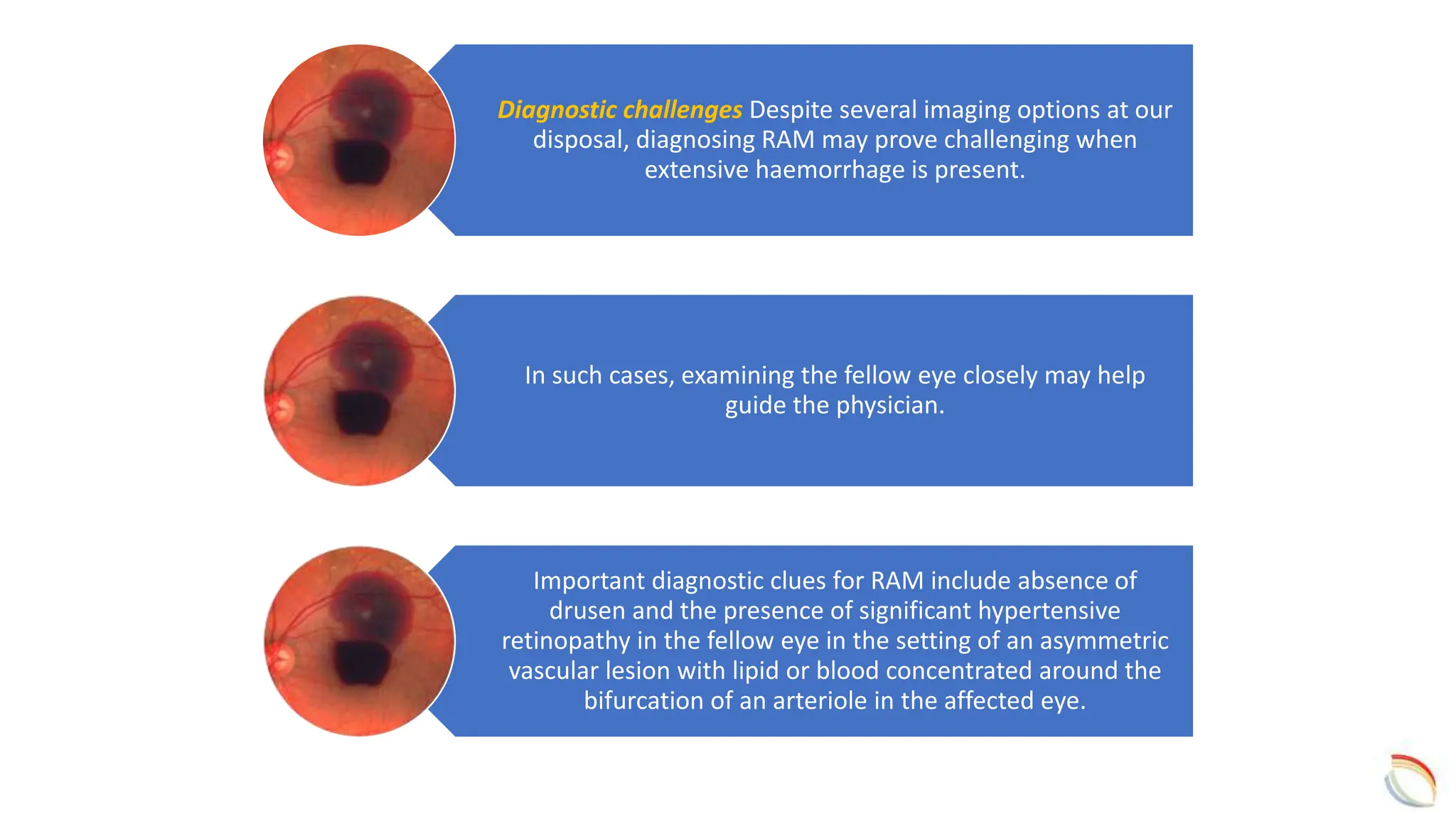 Retinal Artery Macroaneurysm | PPTX