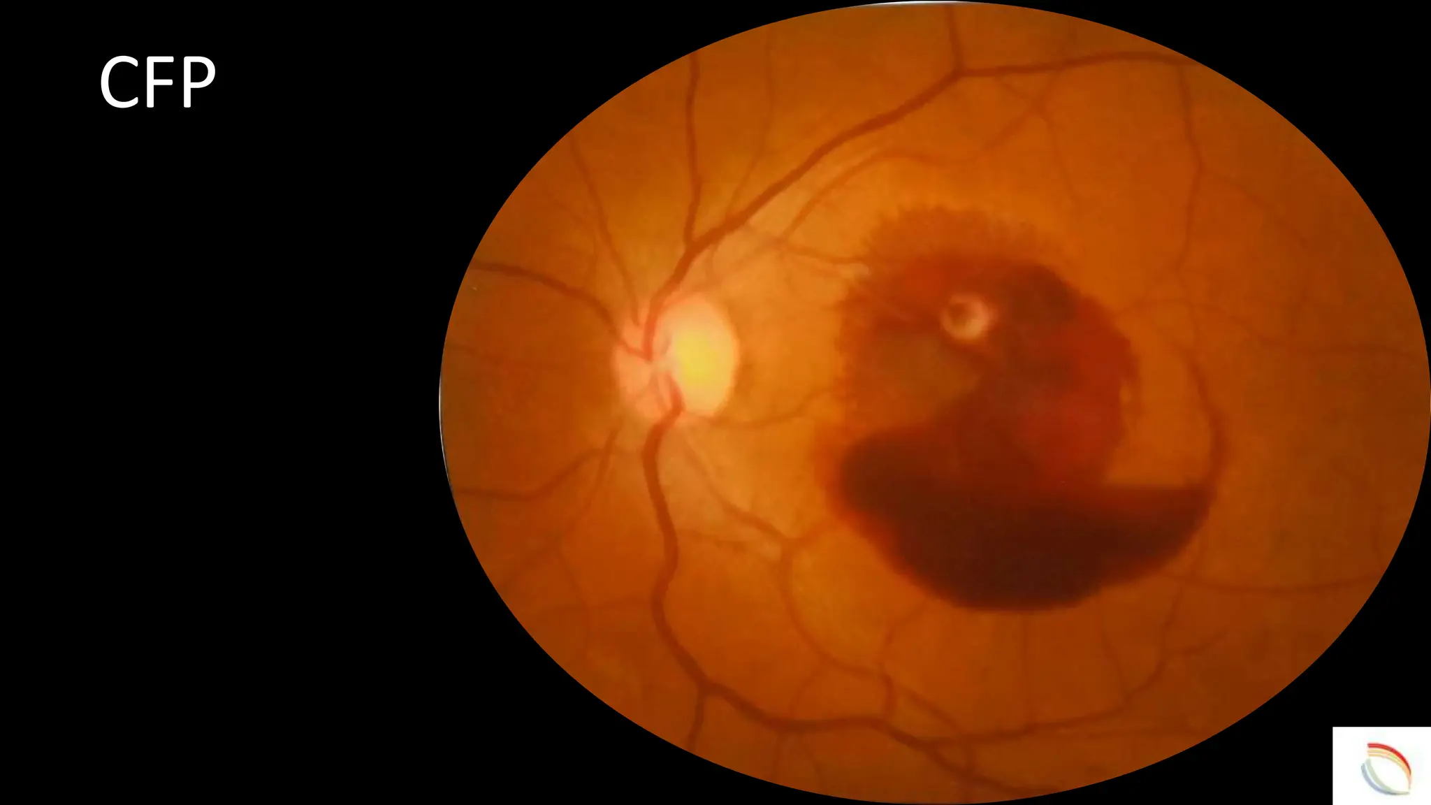 Retinal Artery Macroaneurysm Pptx Eye And Vision Conditions Diseases And Conditions